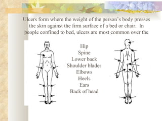 Pressure Ulcer Prevention & Skin Care | PPT