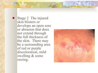 Mild Skin Ulcer