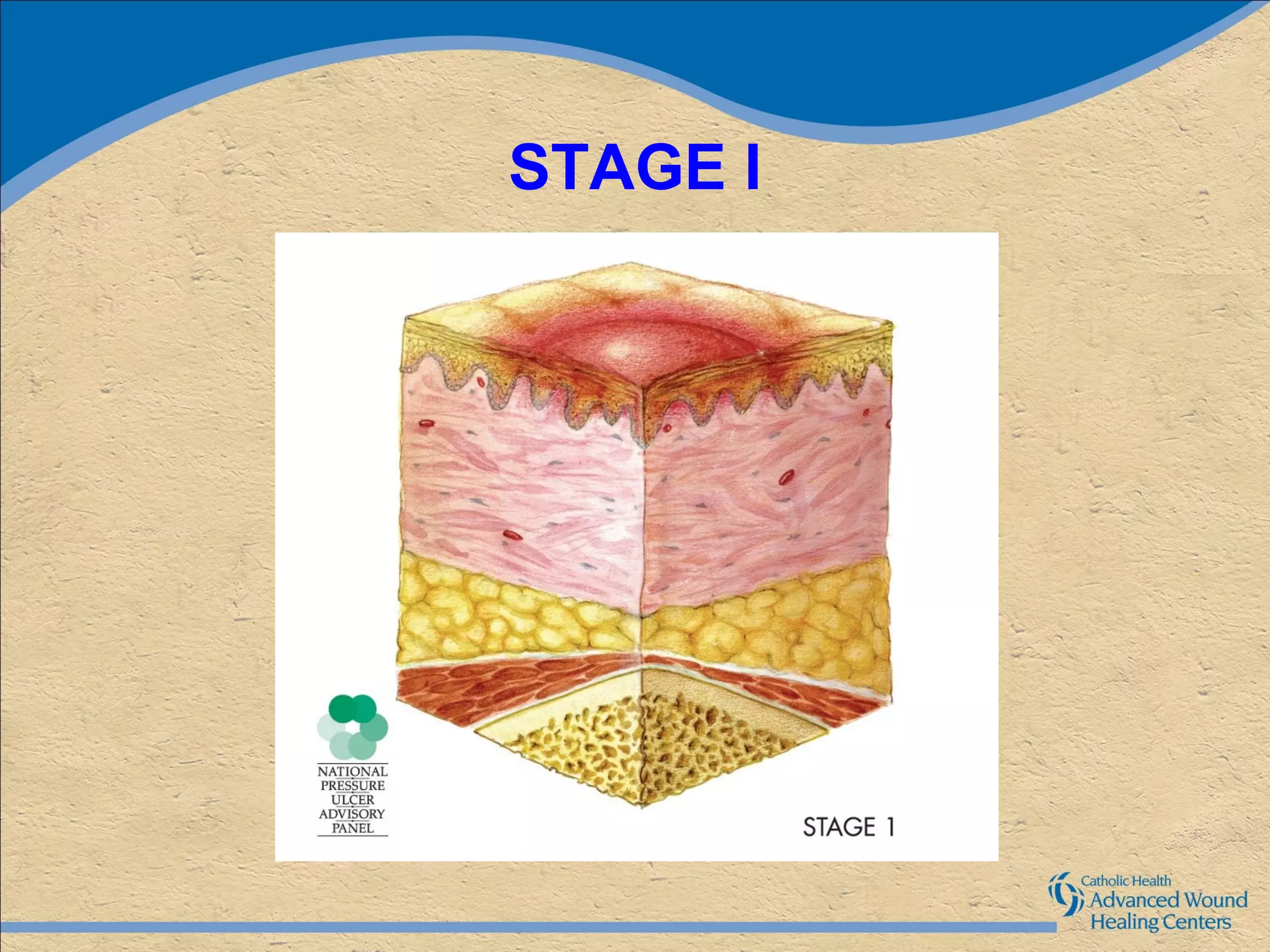 Pressure ulcers, why and how | PPT