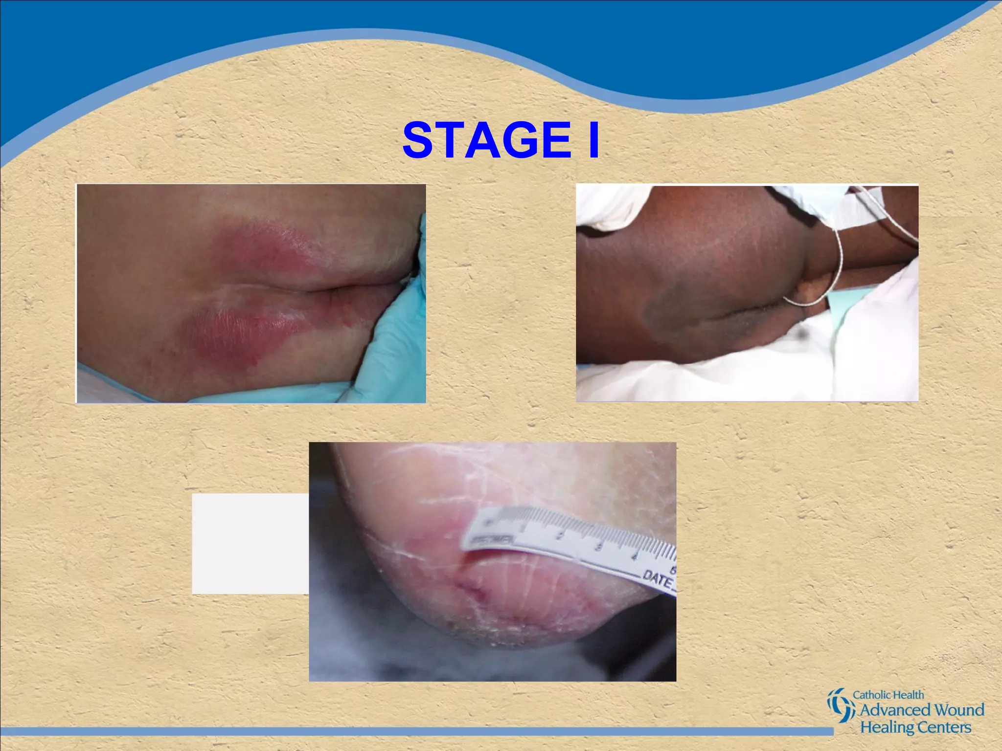 Pressure ulcers, why and how | PPT