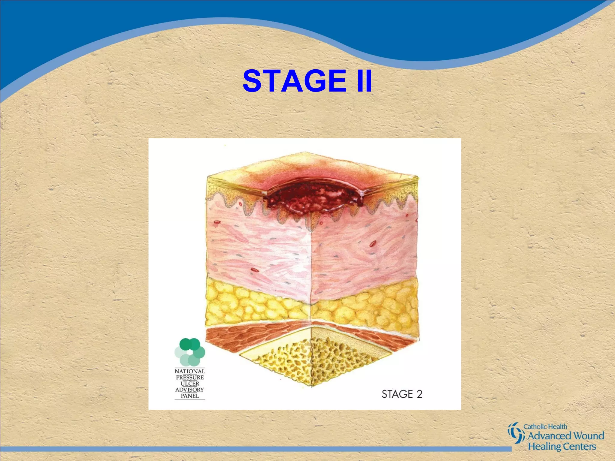 Pressure ulcers, why and how | PPT