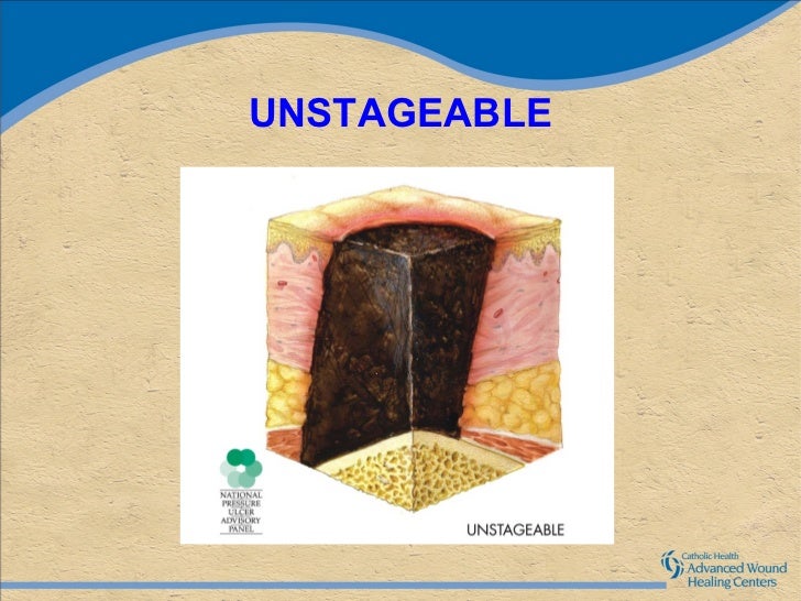 Pressure ulcers, why and how