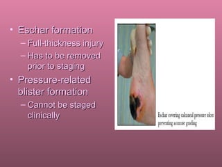 Pressure ulcers | PPT