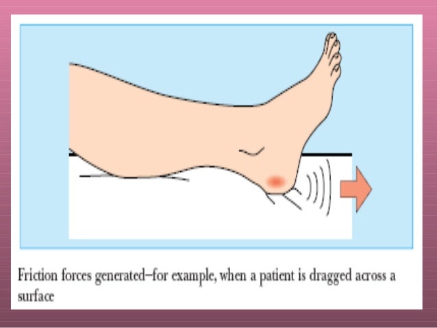 Pressure ulcers