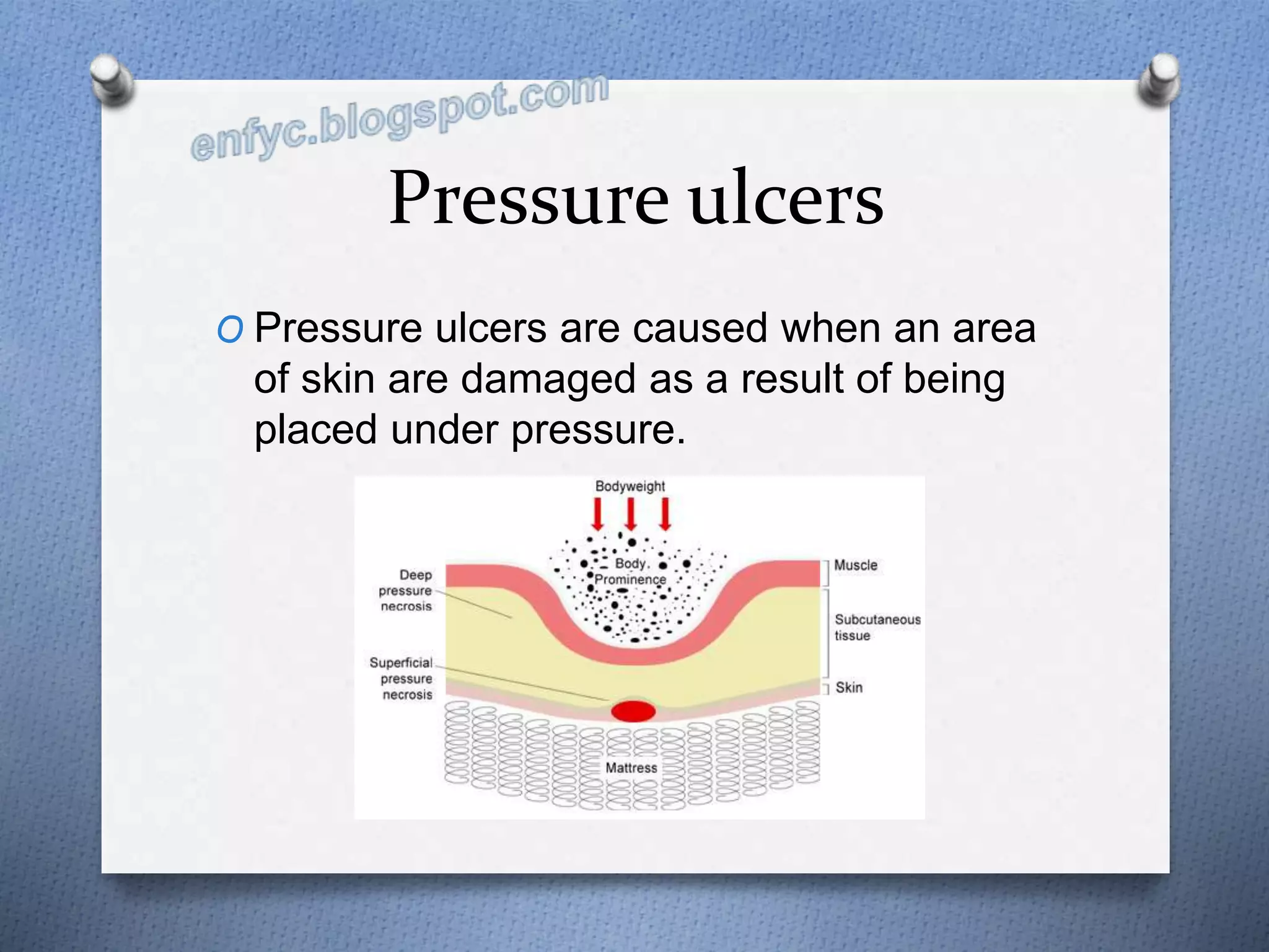 Pressure ulcers | PPT