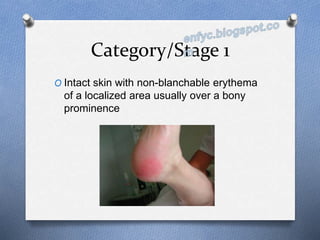 Pressure ulcers | PPT