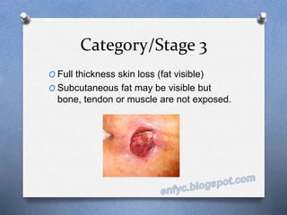 Pressure ulcers | PPTX