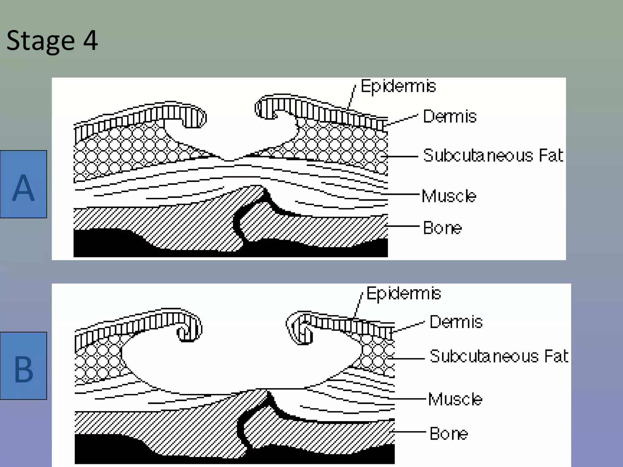 Pressure Sores | PPT