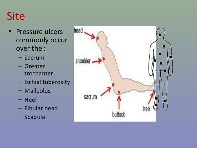 Pressure Sores