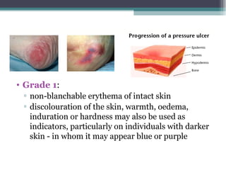Pressure Ulcers - Mussa Mensa | PPT