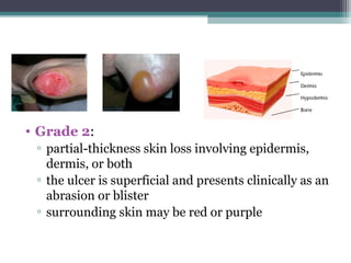 Pressure Ulcers - Mussa Mensa | PPT