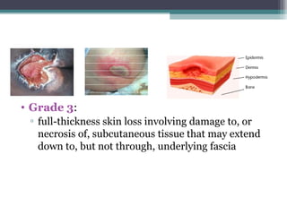 Pressure Ulcers - Mussa Mensa | PPT