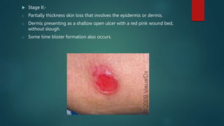 PRESSURE ULCERS.pptx