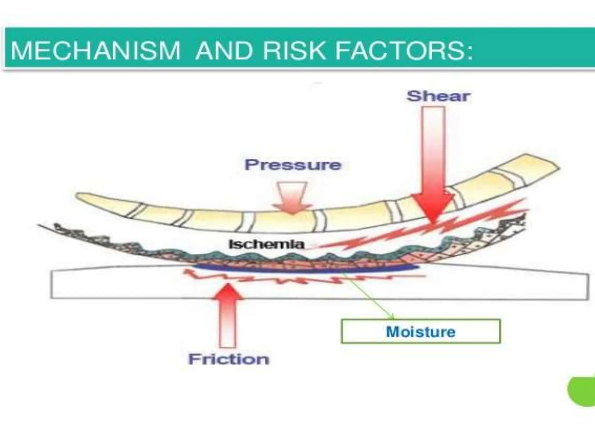 pressure ulcers model.pptx by dr amna hassan | PPTX