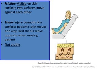 pressure ulcers model.pptx by dr amna hassan | PPTX