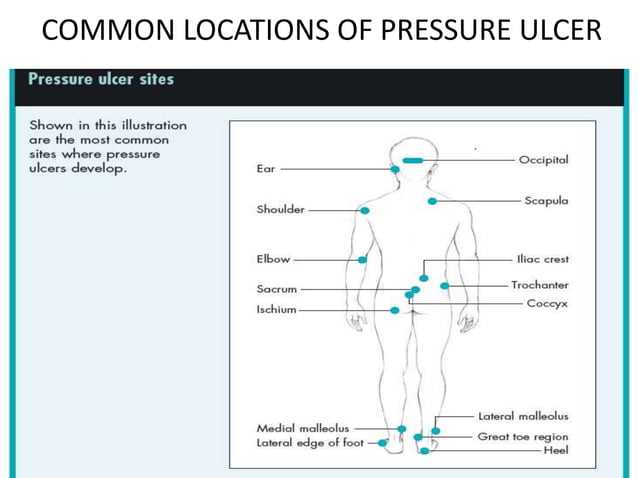 pressure ulcers model.pptx by dr amna hassan | PPTX