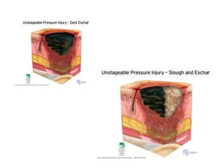 pressure ulcers model.pptx by dr amna hassan | PPTX