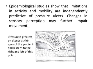 pressure ulcers model.pptx by dr amna hassan | PPTX