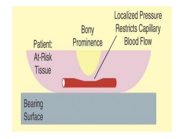 pressure ulcers model.pptx by dr amna hassan | PPTX