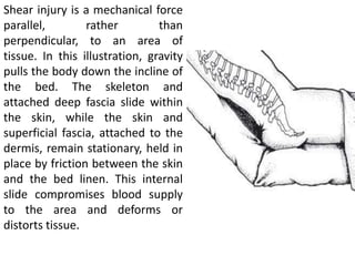 pressure ulcers model.pptx by dr amna hassan | PPTX
