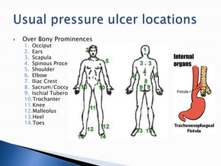 Pressure ulcers presentation | PPSX