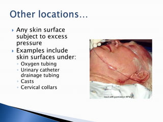 Pressure ulcers presentation | PPSX