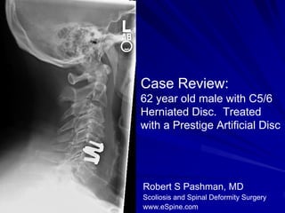 Case Review #6: 62 year old male presented with C5/6 Disc Herniation | PDF