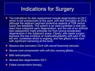 Case Review #5: 46 year old female treated with a Prestige Disc | PPT
