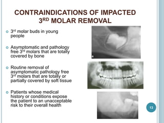Presurgical Assessment of Impacted Molar Tooth | PPTX