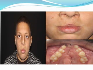 Pre surgical orthopedics in cleft patients .pptx