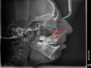Pre surgical orthopedics in cleft patients .pptx