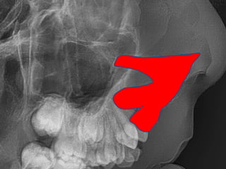 Pre surgical orthopedics in cleft patients .pptx
