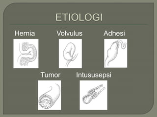 Presus ileus obstruktif dr. gunawan siswadi, sp. b | PPTX
