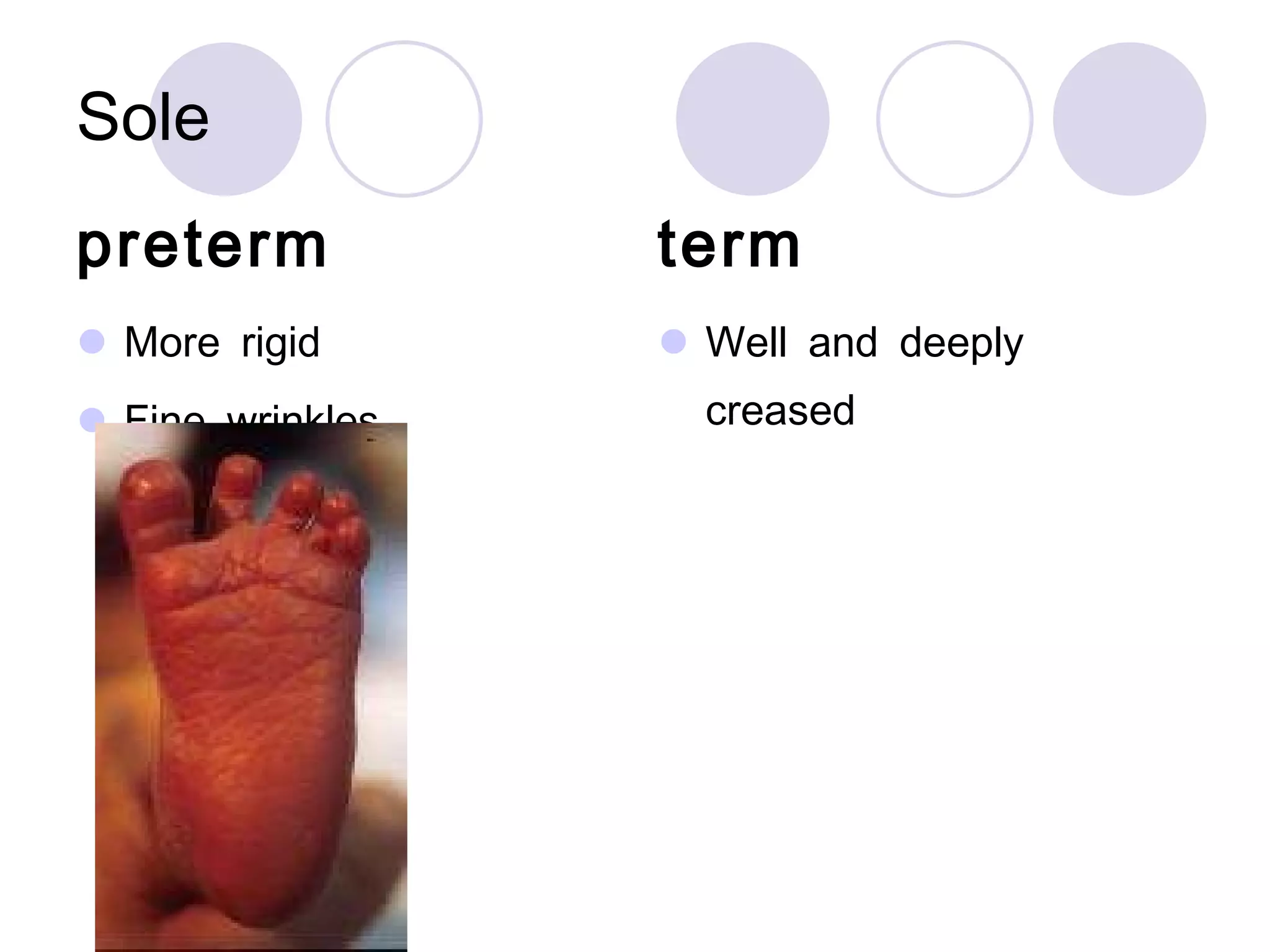 Preterm | PPT