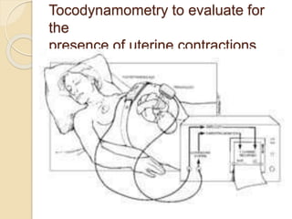 Preterm LABOUR | PPTX