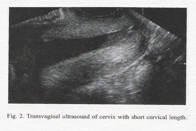 Preterm Labour and Premature Rupture of Membranes Mob: 7289915430, www ...