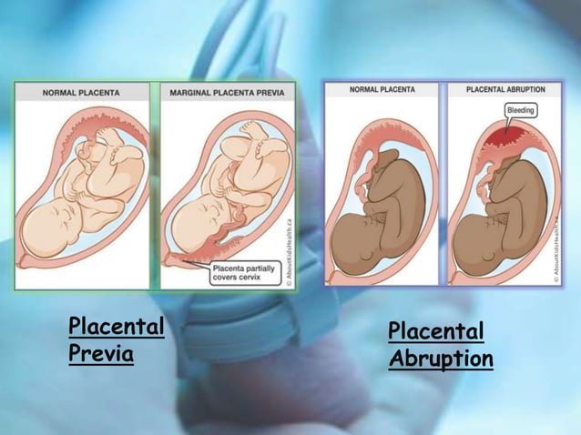 Pre term babies | PPTX | Pregnancy | Reproductive Health