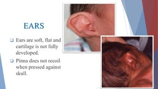 Preterm Neonate | PPTX