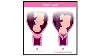 Preterm labor.pptx