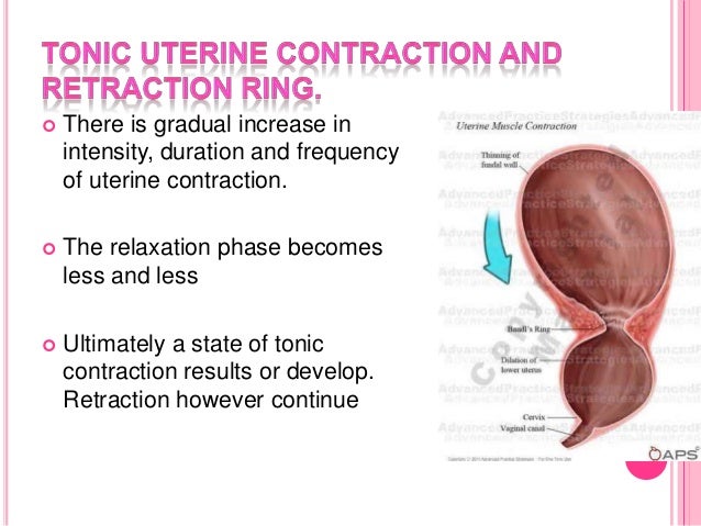 Uterus Contraction Ring Obstructed Labour