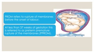 Preterm labour & premature rupture of membranes (IL).pdf