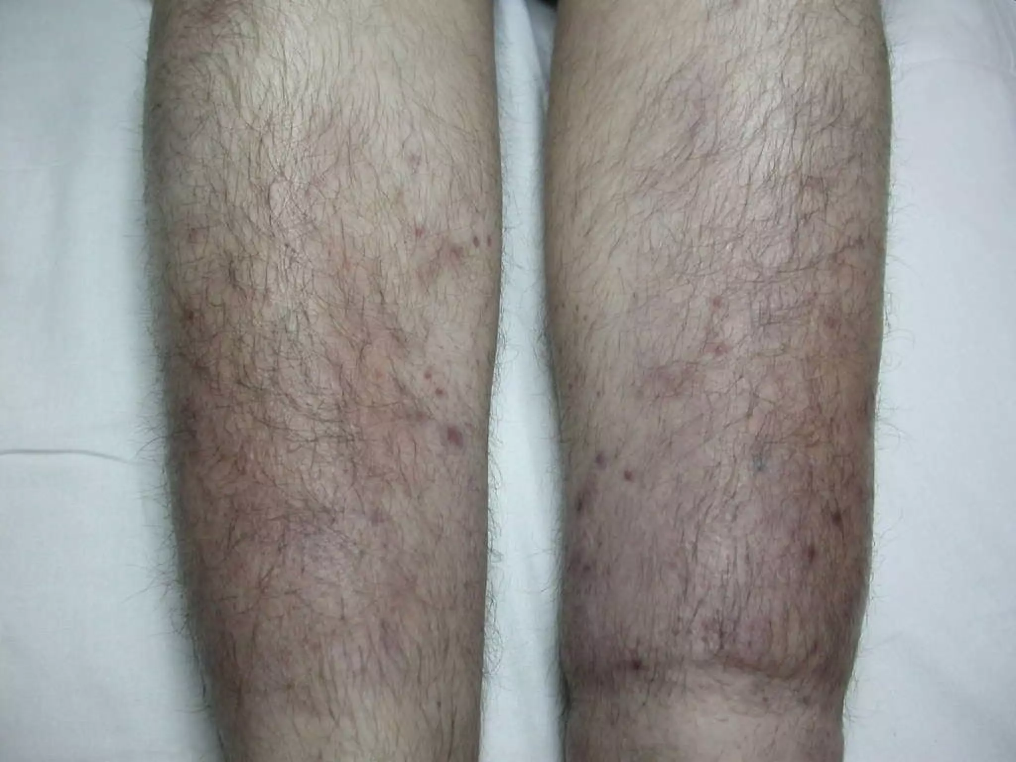 Pretibial myxedema wiyh graves disease[1]. | PPT