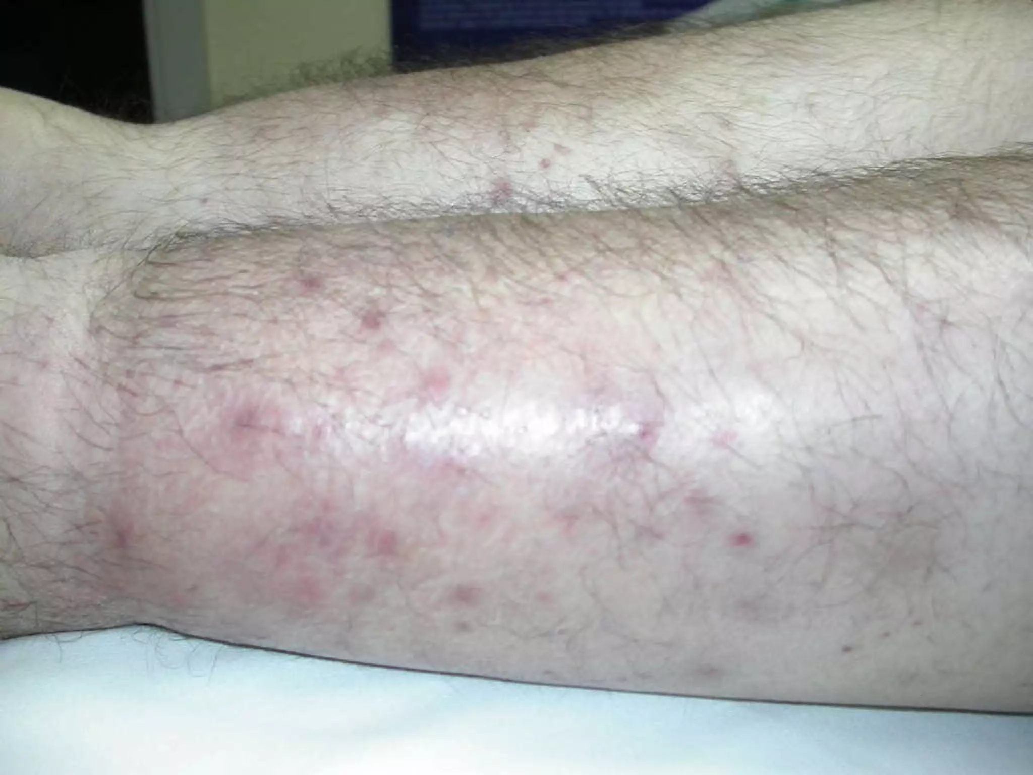 Pretibial myxedema wiyh graves disease[1]. | PPT