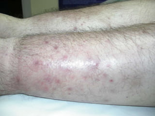 Pretibial myxedema wiyh graves disease[1]. | PPT | Thyroid Disorders ...