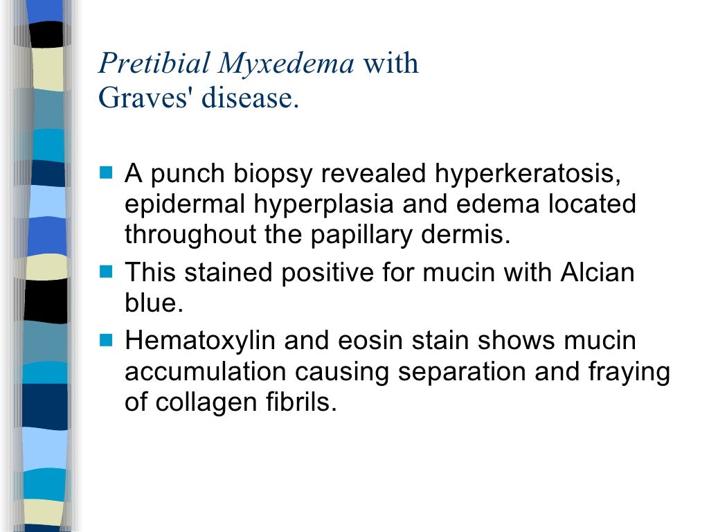 Pretibial Myxedema Wiyh Graves Disease 1