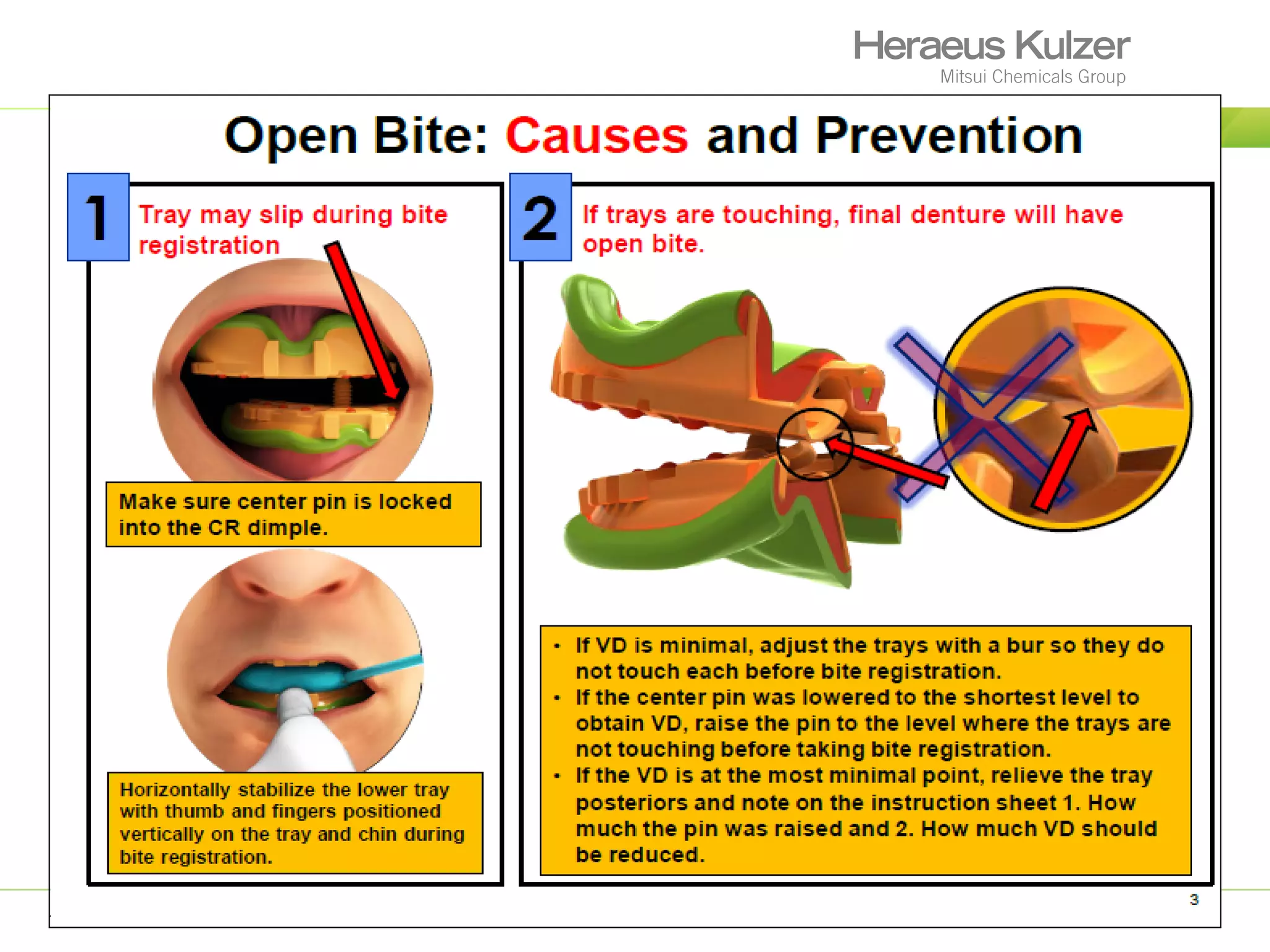 Preventing anterior open bites final | PDF