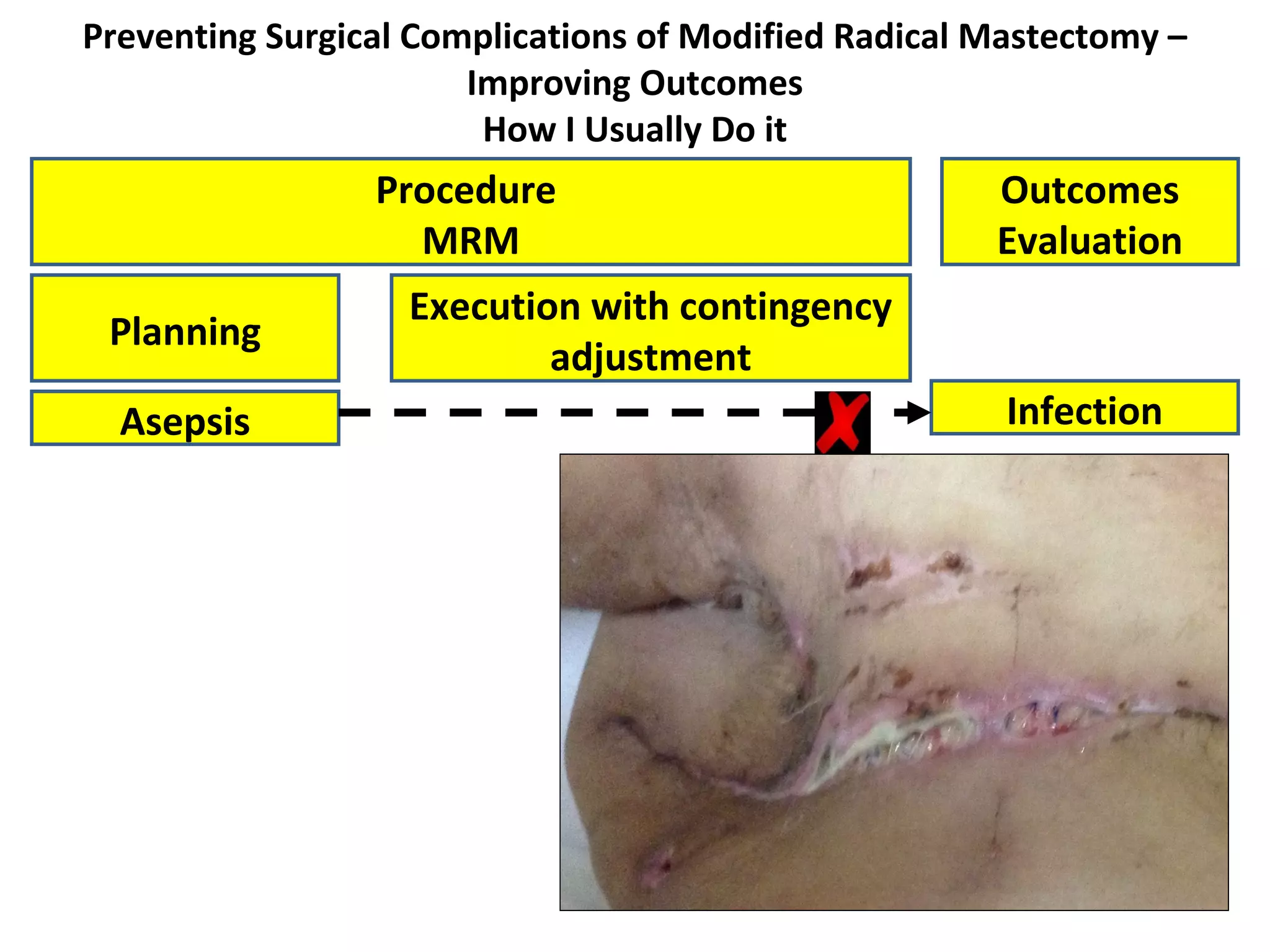 Preventing Surgical Complications of Modified Radical Mastectomy | PPT