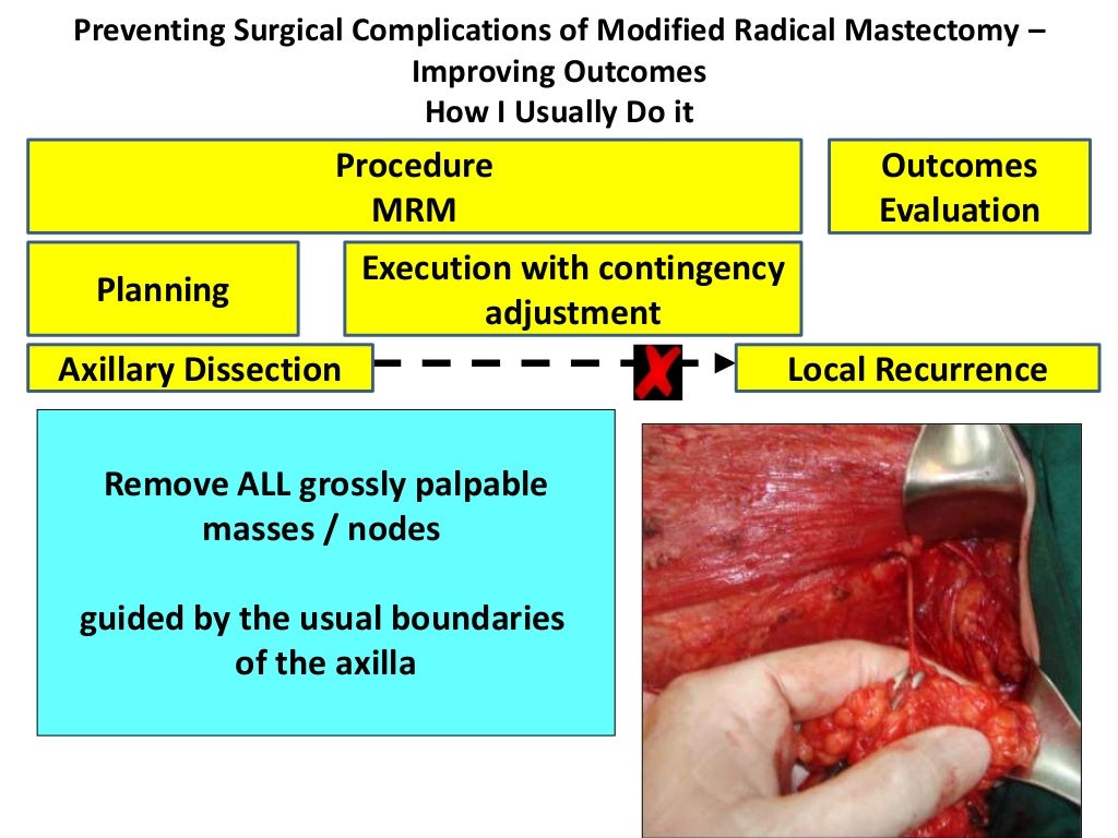Preventing Surgical Complications of Modified Radical Mastectomy - RO…