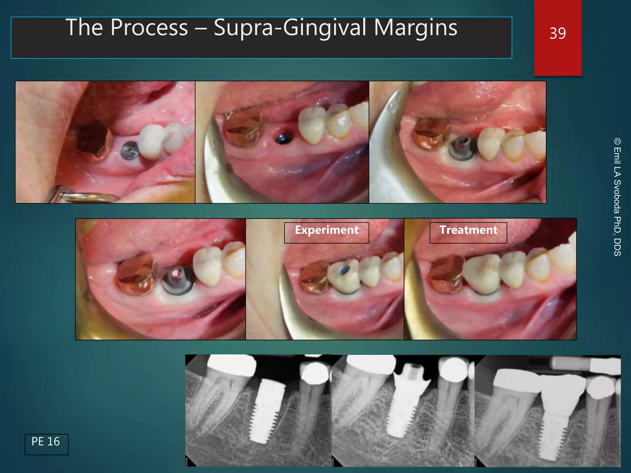 Preventing Peri-implantitis by Safer Prosthesis Installation | PPT