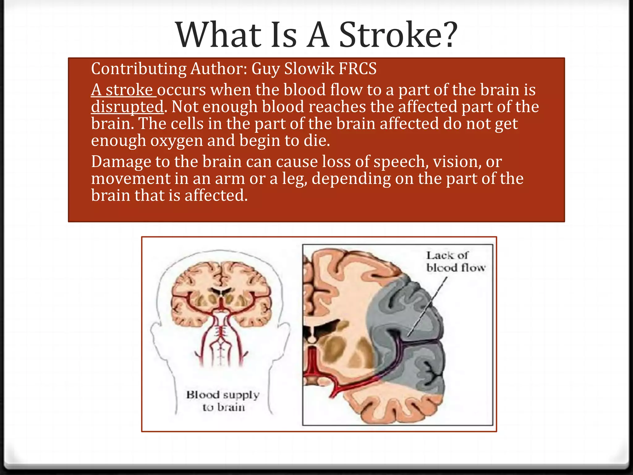 Preventing stroke | PPTX